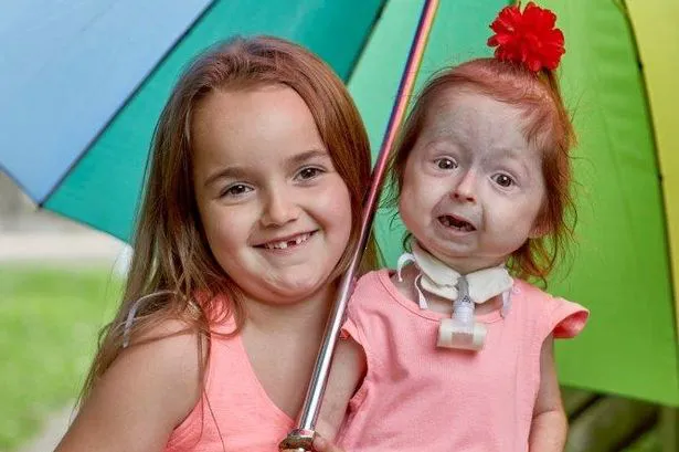 La historia de Isla, la única niña en el Mundo con la "enfermedad de ...